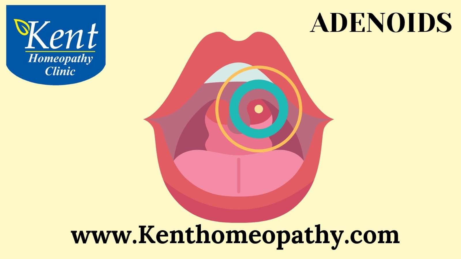 Adenoids | Kenthomoepathy | Powai | Mumbai - Homeopathy Doctor ...