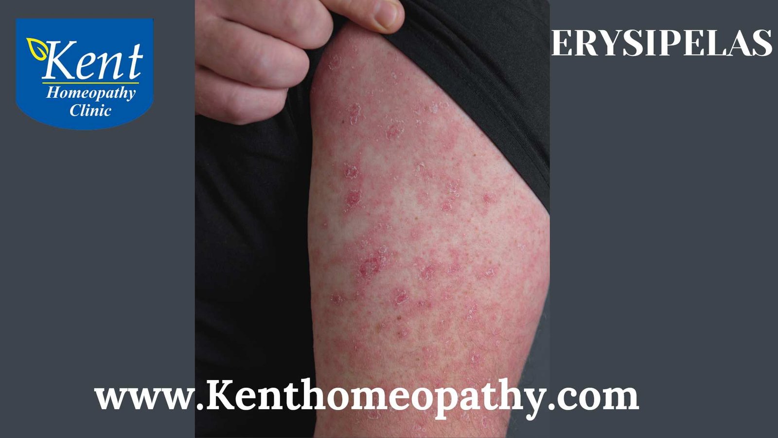 What Is Erysipelas Disease