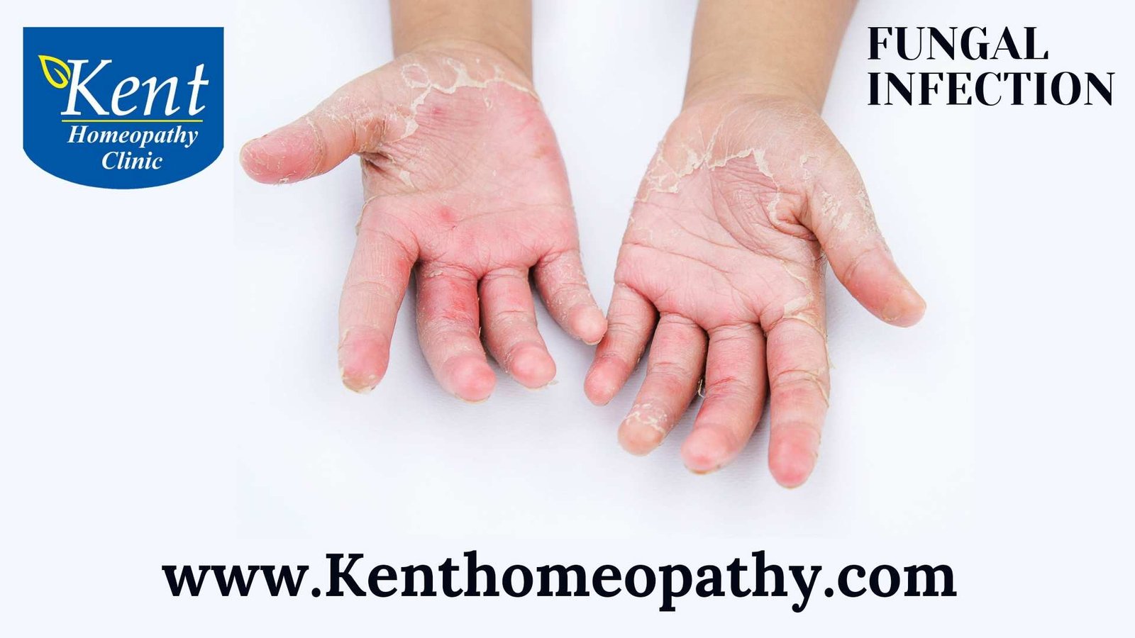 Fungal infection | Kenthomoepathy | Powai | Mumbai - Homeopathy Doctor ...
