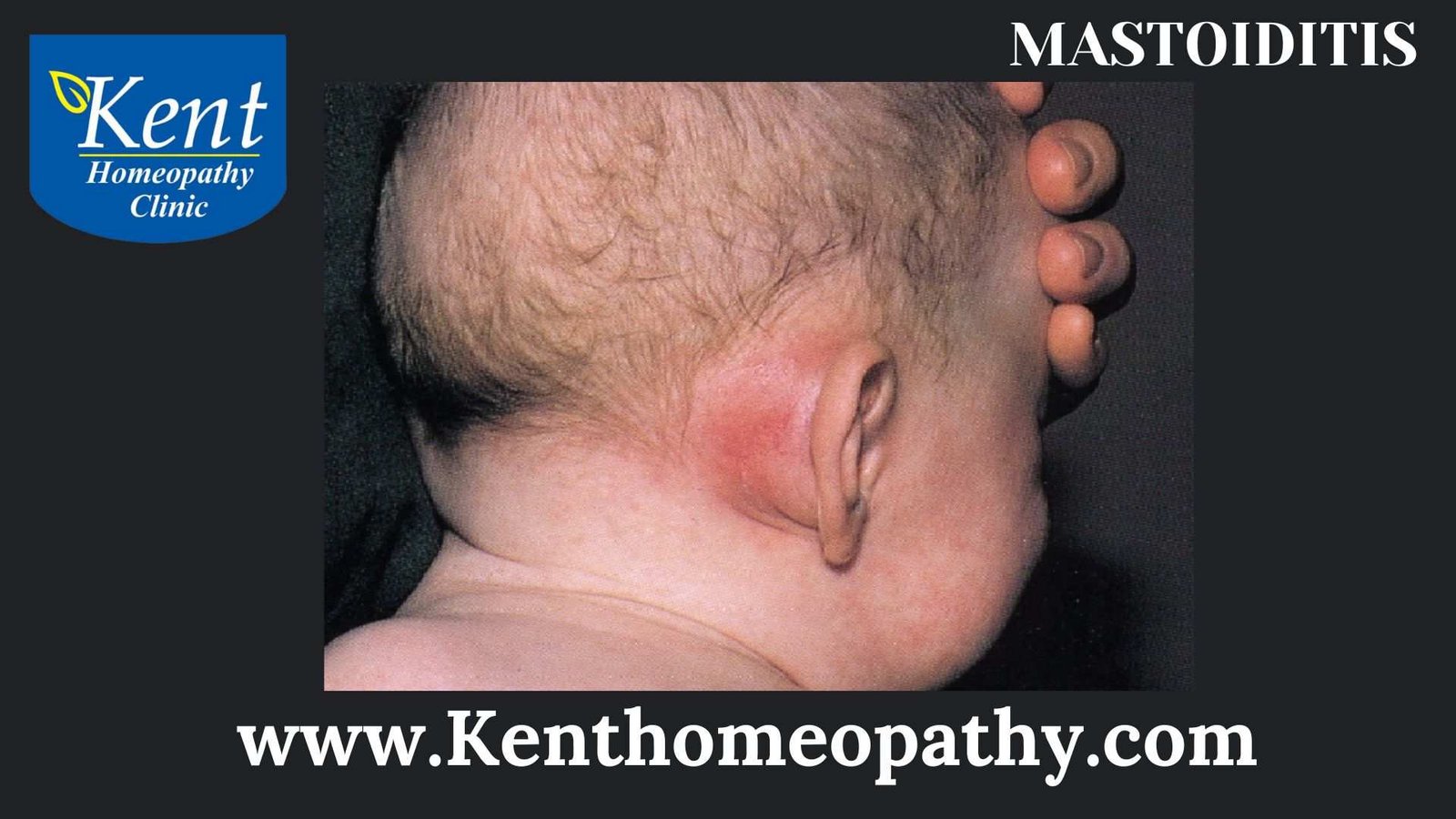 Mastoiditis | Kenthomoepathy | Powai | Mumbai - Homeopathy Doctor ...
