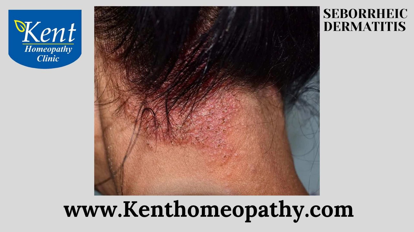 Seborrhoeic Dermatitis | Kenthomoepathy | Powai | Mumbai - Homeopathy ...