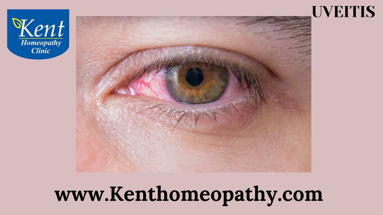 Uveitis | Kenthomoepathy | Powai | Mumbai - Homeopathy Doctor ...