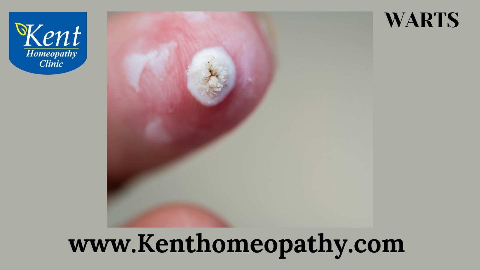 Warts | Kenthomoepathy | Powai | Mumbai - Homeopathy Doctor ...